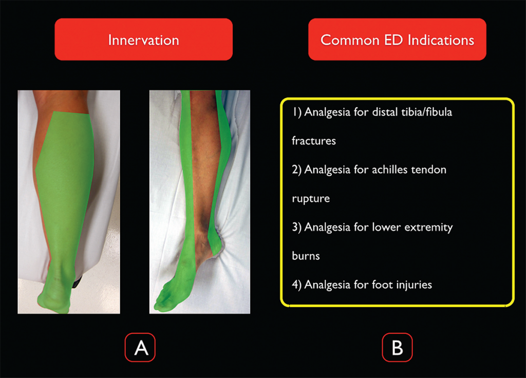 How to Perform Ultrasound-Guided Distal Sciatic Nerve Block in the ...