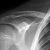 Tips for Diagnosing Occult Fractures in the Emergency Department - ACEP Now