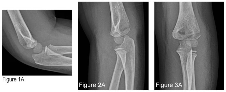 How to Avoid Missing a Pediatric Elbow Fracture - ACEP Now