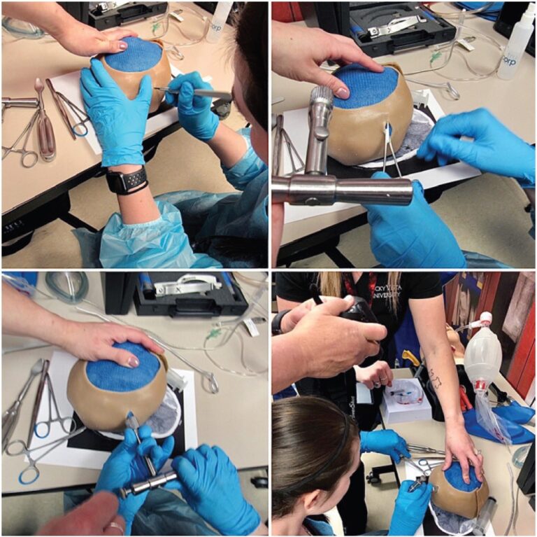 Emergency Department Trephination (Burr Hole) for Epidural Hematoma ...