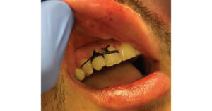 A Novel Technique to Treat a Dental Avulsion - ACEP Now