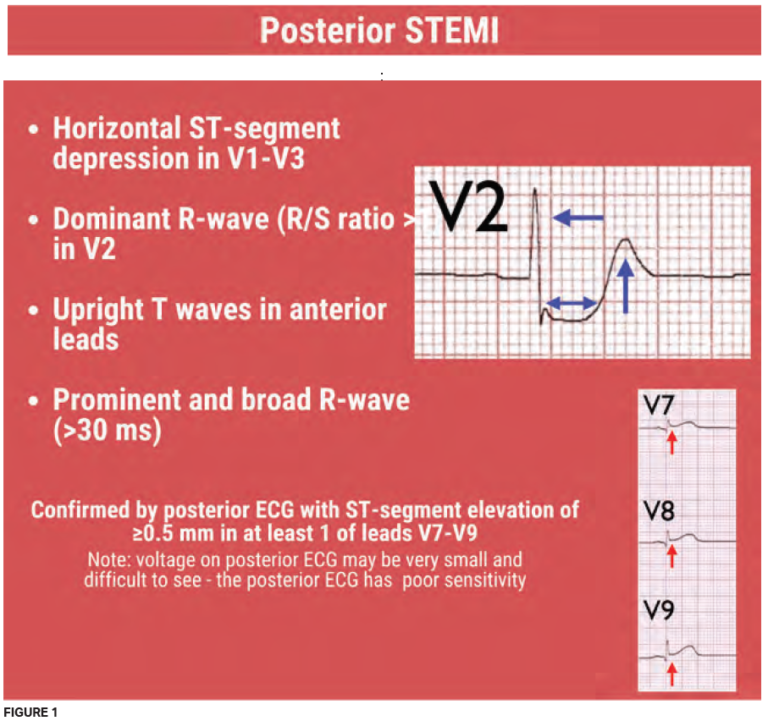 stemi figure 1 dec 2022 - ACEP Now