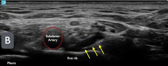 How To: The Ultrasound-Guided Supraclavicular Brachial Plexus Block ...
