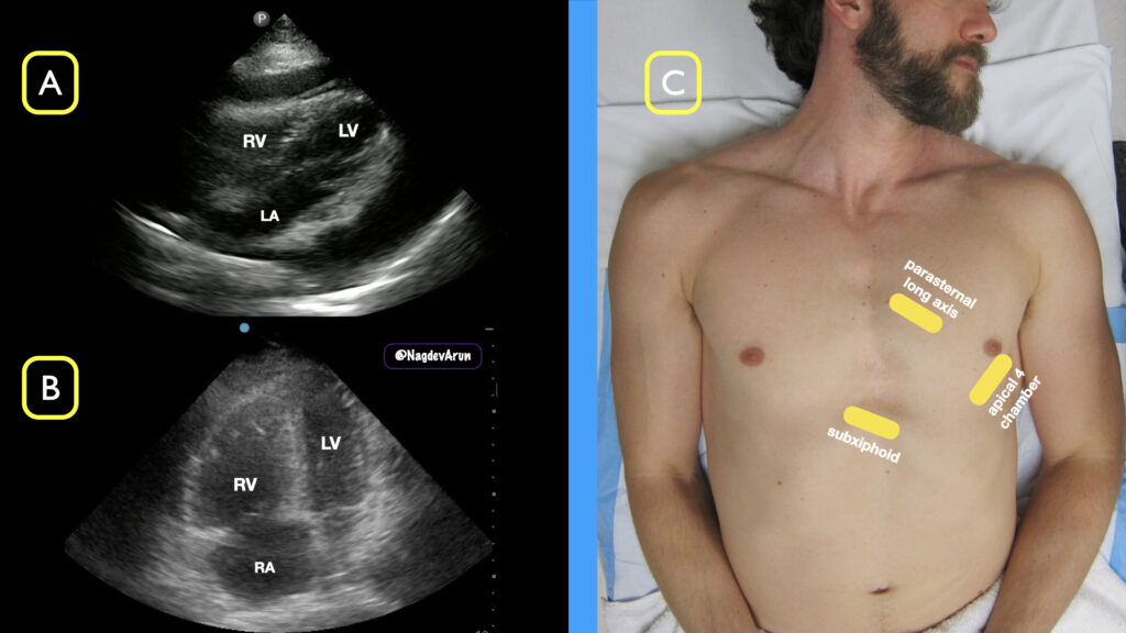 How To Safely Incorporate Ultrasound Into Cardiac Arrest Resuscitation ...