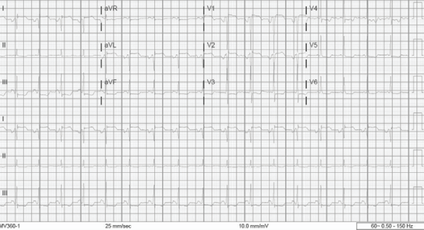 Case Report: Pancreatitis Mimics STEMI - ACEP Now