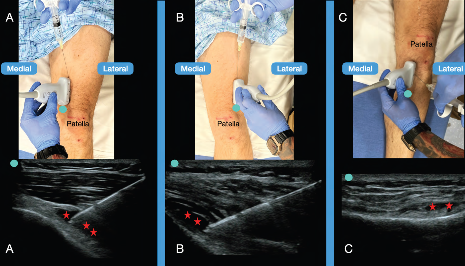 The Ultrasound-Guided Genicular Nerve Block - ACEP Now