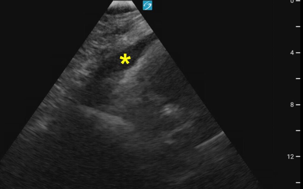 Case Report: Rapid Diagnosis of Acute Aortic Dissection with POCUS ...
