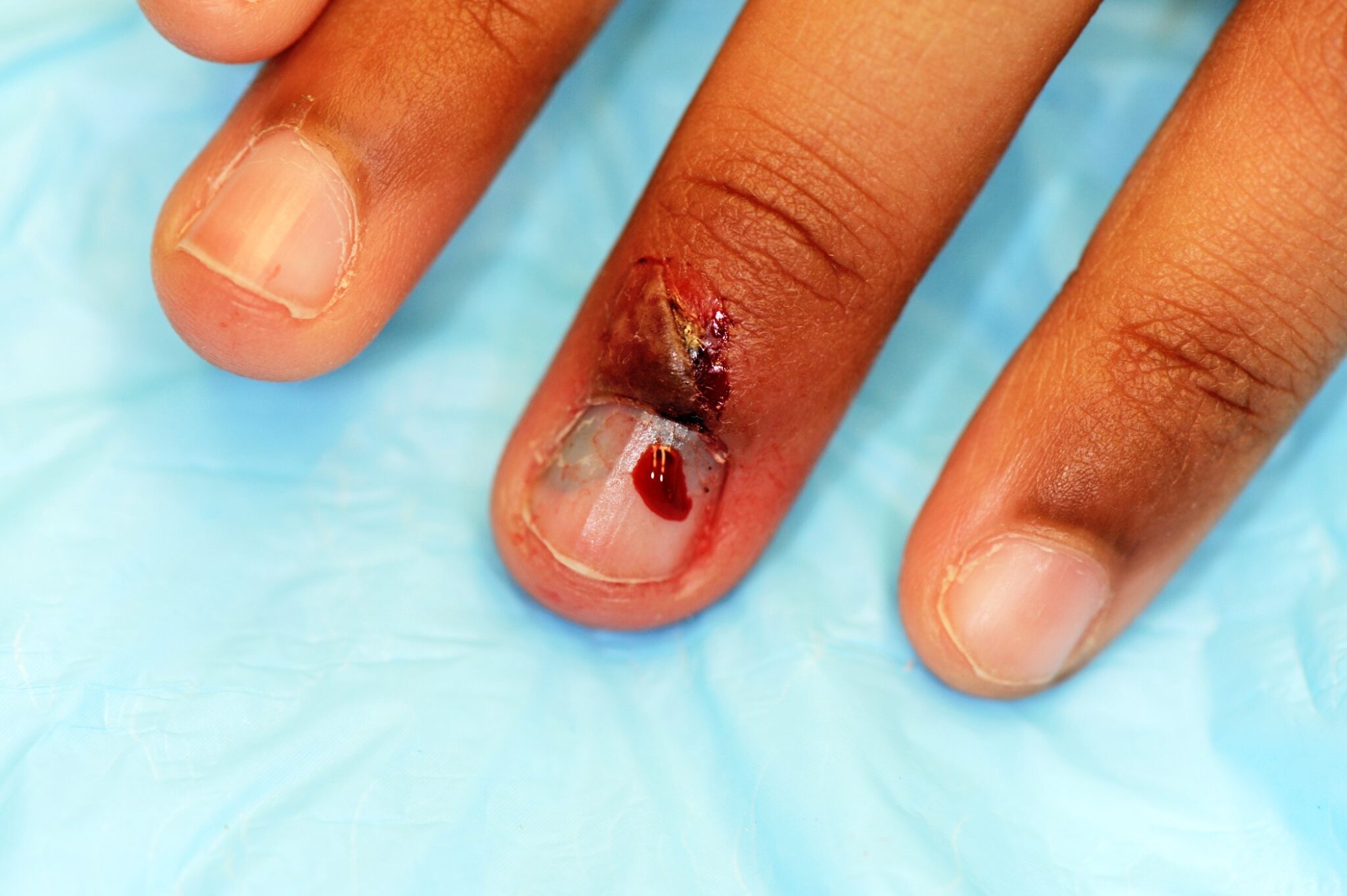 Nail Bed Injuries: What to Do—or Not to Do - ACEP Now